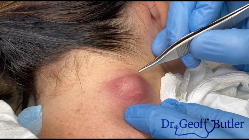 Successful Removal of a Large Epidermal Cyst from the Mid-Chest: A Comprehensive Procedure ...